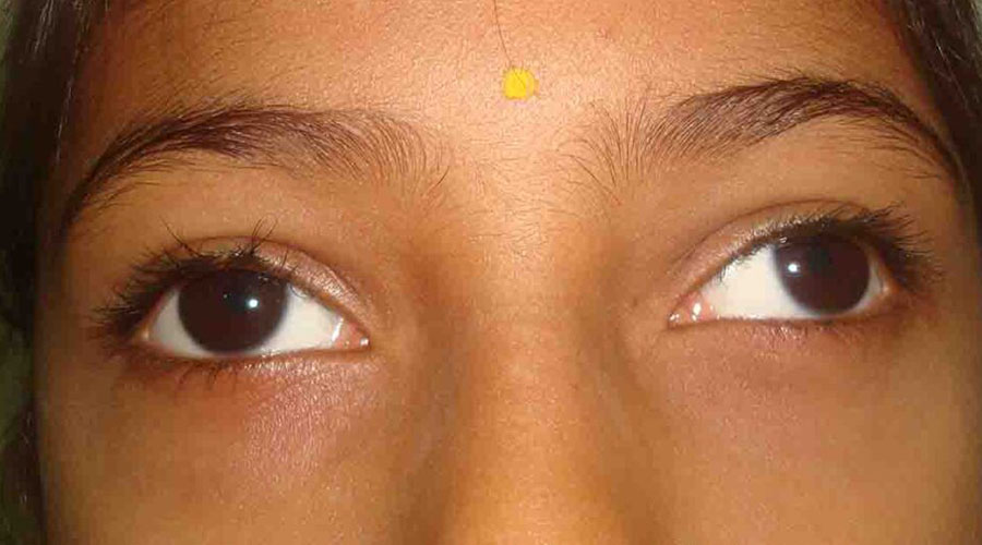 Best Squint (Strabismus) Treatment in Patna | Squint Specialist